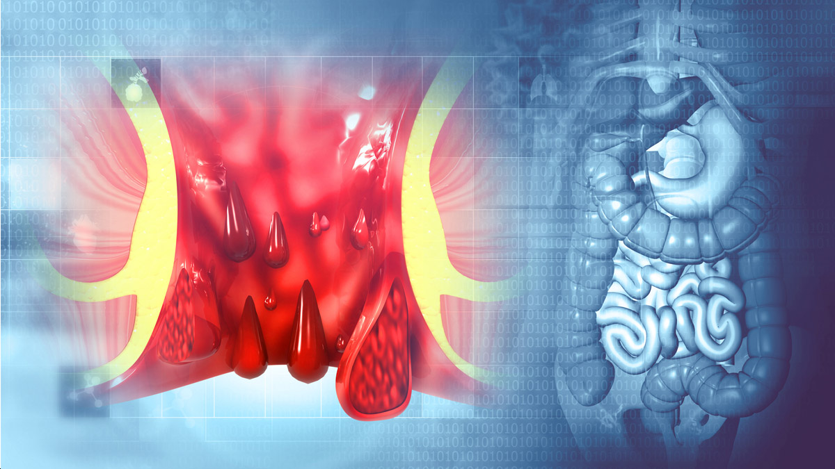 Hämorrhoiden – Was hilft? - GESUNDHEITHEUTE - wohldosiert infomiert